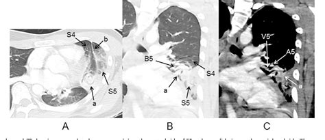 Figure 1 From Idiopathic Spontaneous Pulmonary Torsion Of The Lingula A Case Report Semantic