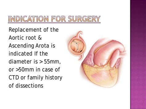 Enlarged Aorta Treatment Observe Or Operate When