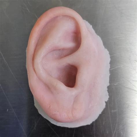 Saharra T On Linkedin My First Implant Retained Prosthesis 👂 16