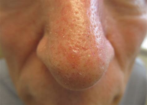 Bcc On The Nose Basal Cell Carcinoma Picture Mr Tehrani Mohs Surgeon Bcc On The Nose Basal Cell Carcinoma Picture Mr Tehrani Mohs Surgeon