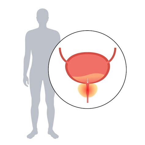 Premium Vector Prostatitis Inflammation Problem