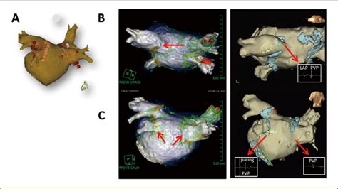A Pulmonary Vein Pv Isolation Setting In The First Session Red Download Scientific