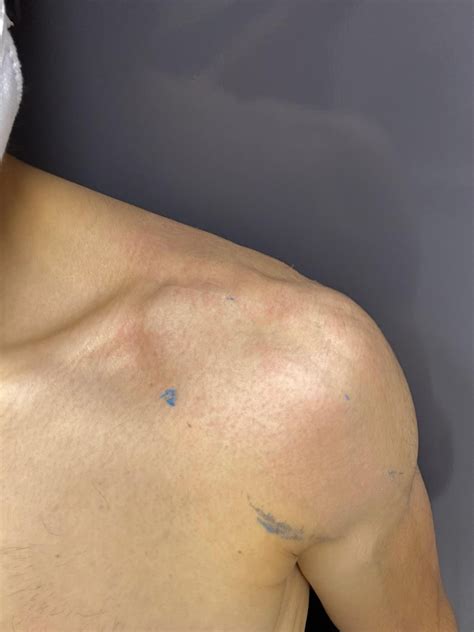 Acromioclavicular Dislocation Rmedicaladvice