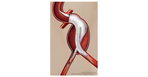 First Patient Enrolled In Investigational Study Of The Gore® Excluder