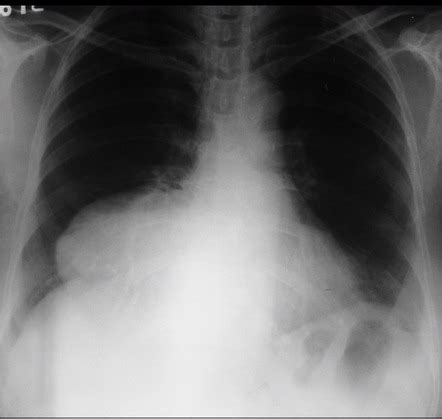 Cystic Mediastinal Masses Radiology Reference Article