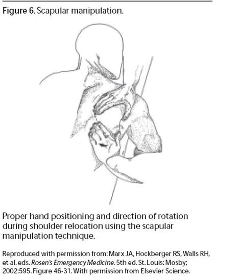 Manipulation Shoulder Procedure At Lois Horning Blog