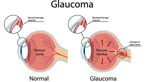 Exploring The Enhanced Treatment Algorithm For Effective Glaucoma Care