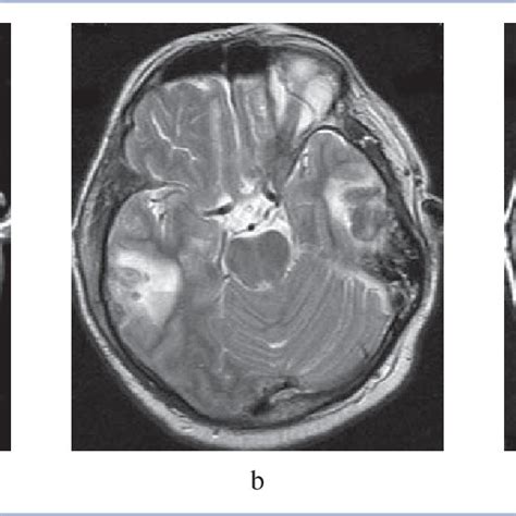 MRI Signs Of Diffuse Axonal Injury With Bilateral Midbrain Lesions Download Scientific Diagram