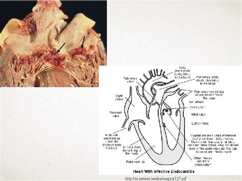 Pathology Of Rheumatic Heart Disease Infective Endocarditis And