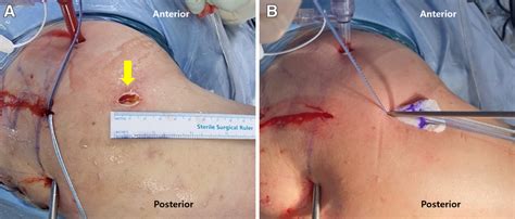 Graft Shuttling Into The Subacromial Space Of The Right Shoulder In The