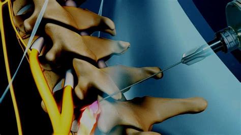 Medial Branch Nerve Block Vs Facet Injection Whats The Difference