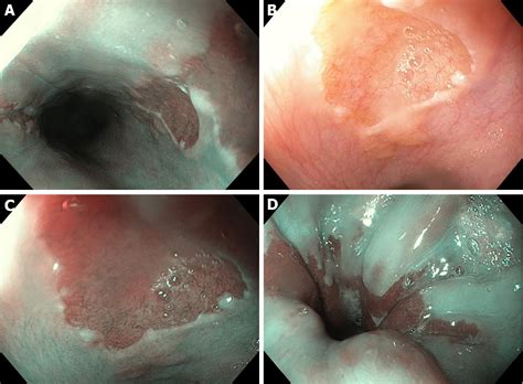 Figure 1 From Issues And Controversies In Esophageal Inlet Patch