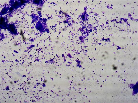 Into The Roots Granulomatous Lymphadenitis With Giant Cells