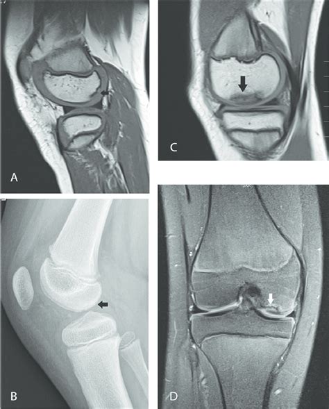 Femoral Ossification Variant In An 8 Year Old Boy Ab Versus
