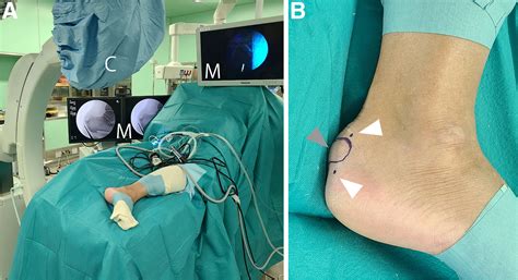 Fluoroscopic And Endoscopic Calcaneal Exostosis Resection And Achilles