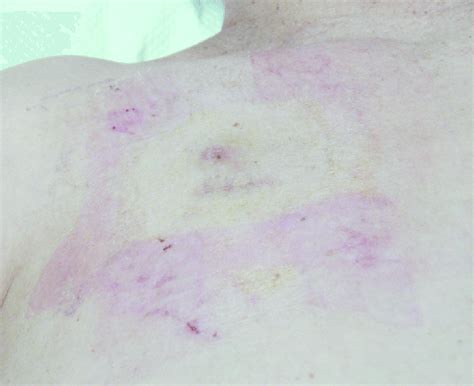 Adhesive Dermatitis Erythema Of The Skin Is Correlated With The