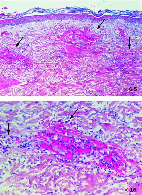 Fatal Allergic Vasculitis Associated With Celecoxib The Lancet