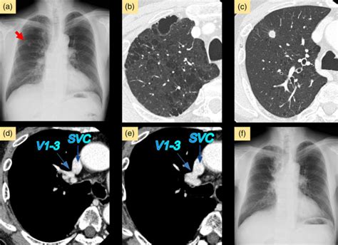 Right S3 Segmentectomy For Lung Cancer With Partial Anomalous Pulmonary