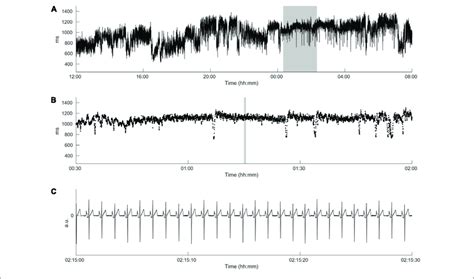 Heart Rate Complexity Of The Control Patient With Normal Heart Rate