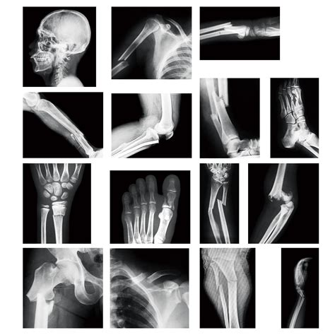 15 Pcs Broken Bones X Ray Set Human X Rays Black And
