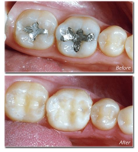 Amalgam Filling Removal Maryland Holistic Dentist