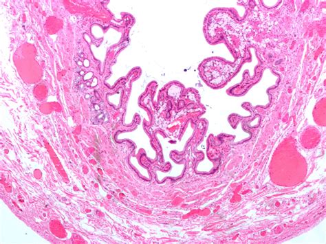 Cholesterolosis Of Gallbladder