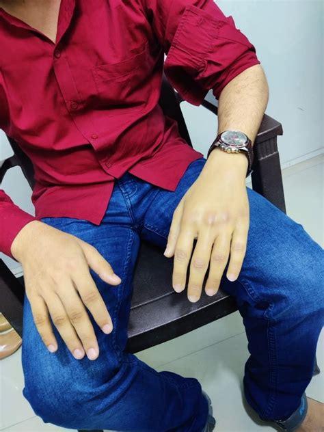 External Use Silicone Partial Hand Prosthesis Below The Elbow At