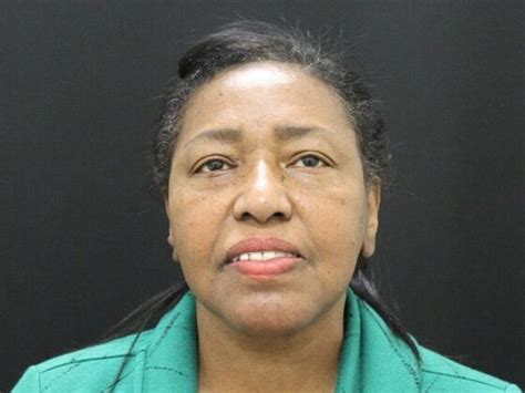 Case 40 Face And Neck Lifts Before And After Gallery