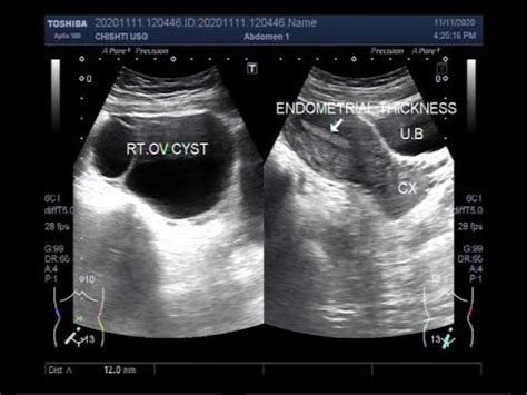 Ultrasound Video Showing An Ovarian Cyst With A Daughter Cyst And