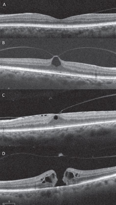 Vitreous Opacities Benign Or Serious