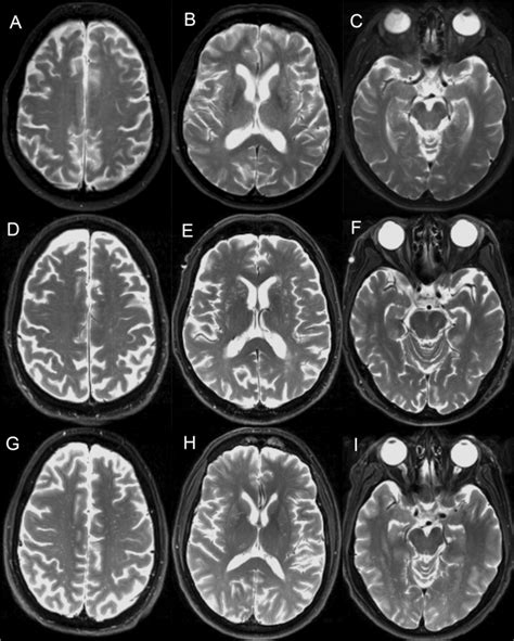 Examples Of Mri Visible Pvs Across The Ad Spectrum A C A Female