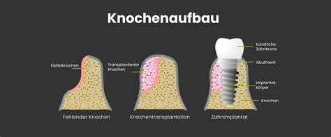 Knochenaufbau Bei Zahnimplantaten Wie Erhöhe Ich Die Lebensdauer