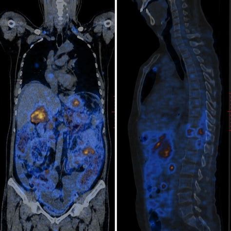 Positron Emission Tomography Computed Tomography Of The Whole Body At Download Scientific