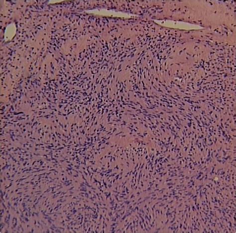 Schwannoma Neurilemoma Tumor Surgery Network