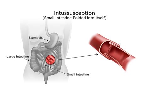 Possible Complications And Side Effects Of Weight Loss Surgery My