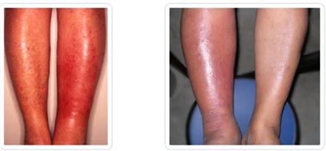 Cellulitis Flashcards Quizlet