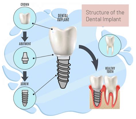 Dental Implants Cleveland Teeth Implants From 3999