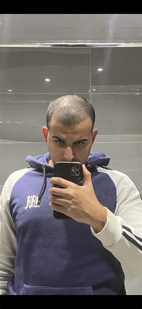 8 Months Finasteride Minoxidil And Derma Pen I Think If I Didnt Do