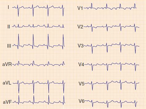Pulmonary Embolism S1q3t3 Ecg