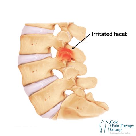 Lumbosacral Facet Syndrome Treatments Sfspf