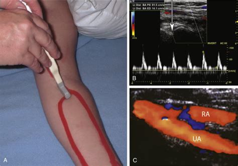 Assessment Of Upper Extremity Arterial Disease Radiology Key