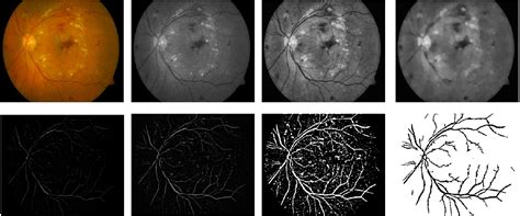 Figure 2 From Diabetic Macular Edema Detection And Severity Grading