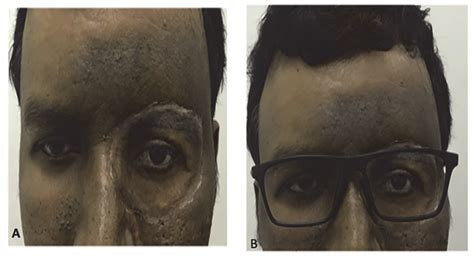 A Rehabilitation Of The Orbital Socket With Prosthesis B Glasses