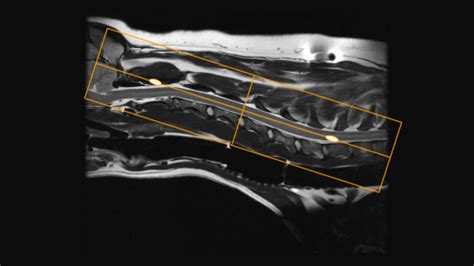 Brachial Plexus Mri Knowledge Portal