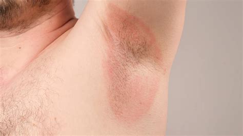 8 Tips To Prevent Chafing