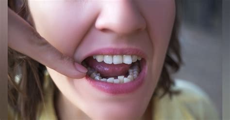 6 Reasons Teeth Shift Dentistry Iq