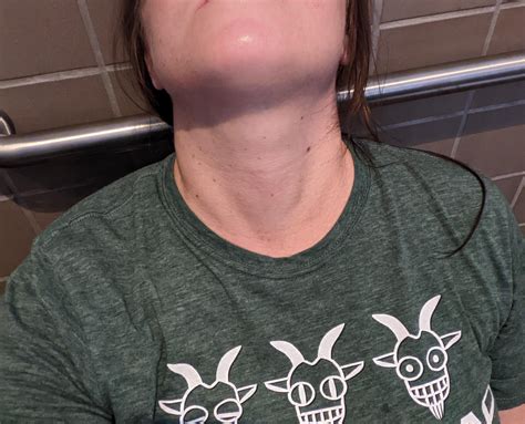 Swollen Thyroid Does It Look Like I Have A Possible Swollen Thyroid I