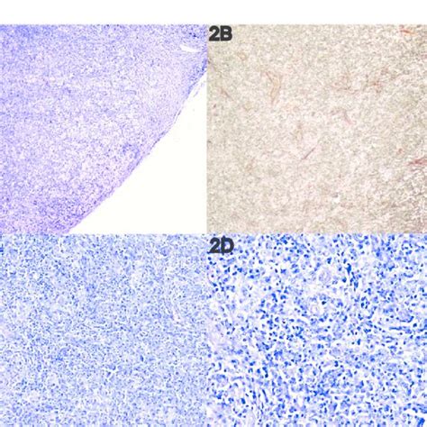 Microphotograph Showing Diffuse Effacement Of Lymph Node Architecture Download Scientific