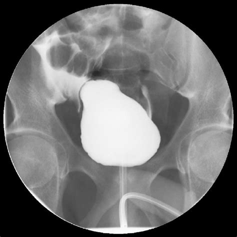 E Fluoroscopic Cystourethrogram On Day 7 After Original Admission