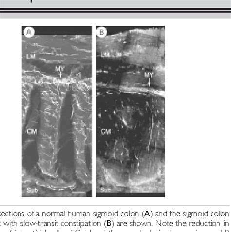 Figure 2 From Pathophysiology Of Chronic Constipation And Ibs Semantic Scholar
